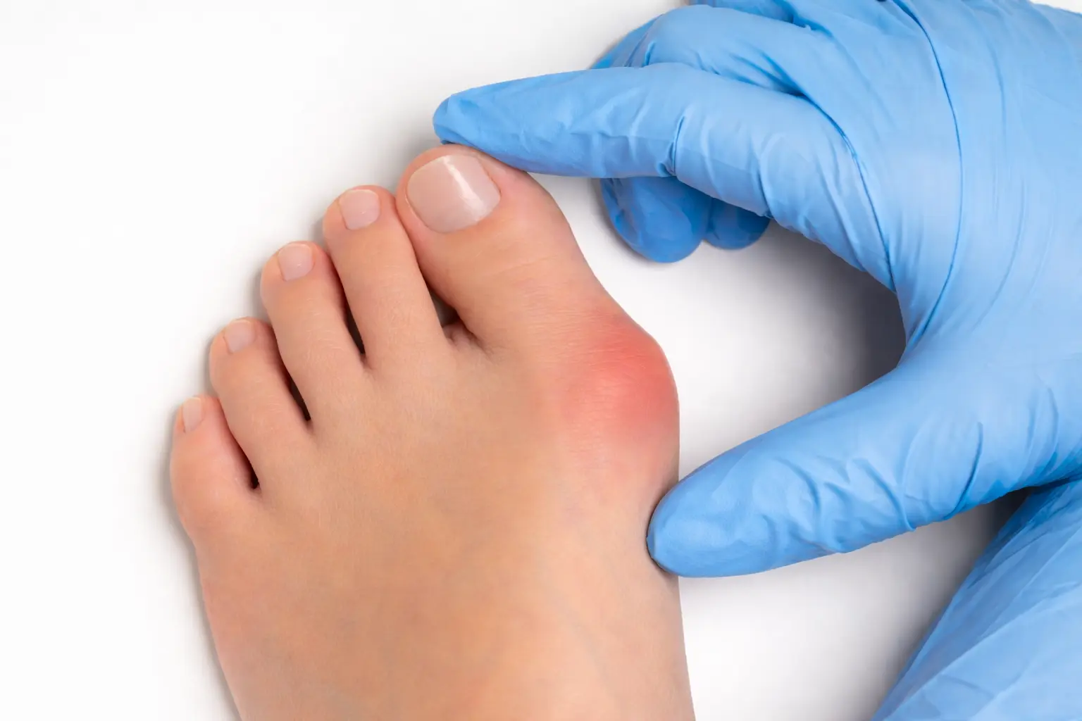 Bunion surgery – Wolky